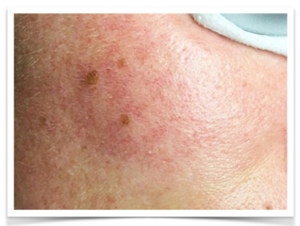 Traitement de l'érythrose faciale - Centre Laser Marseille Estitix